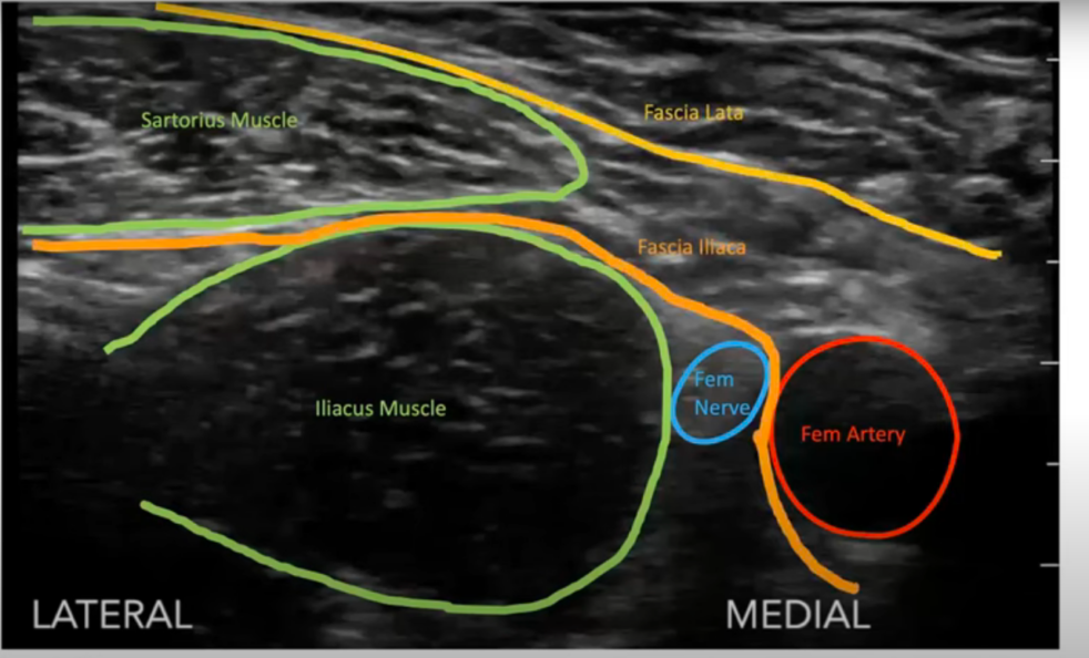 Image Review with Dr. Alyse Volino, Ultrasound Fellow: Fascia Iliaca ...