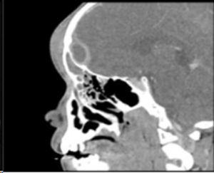 Forehead Swelling by Dr. Edward Guo - EM Daily