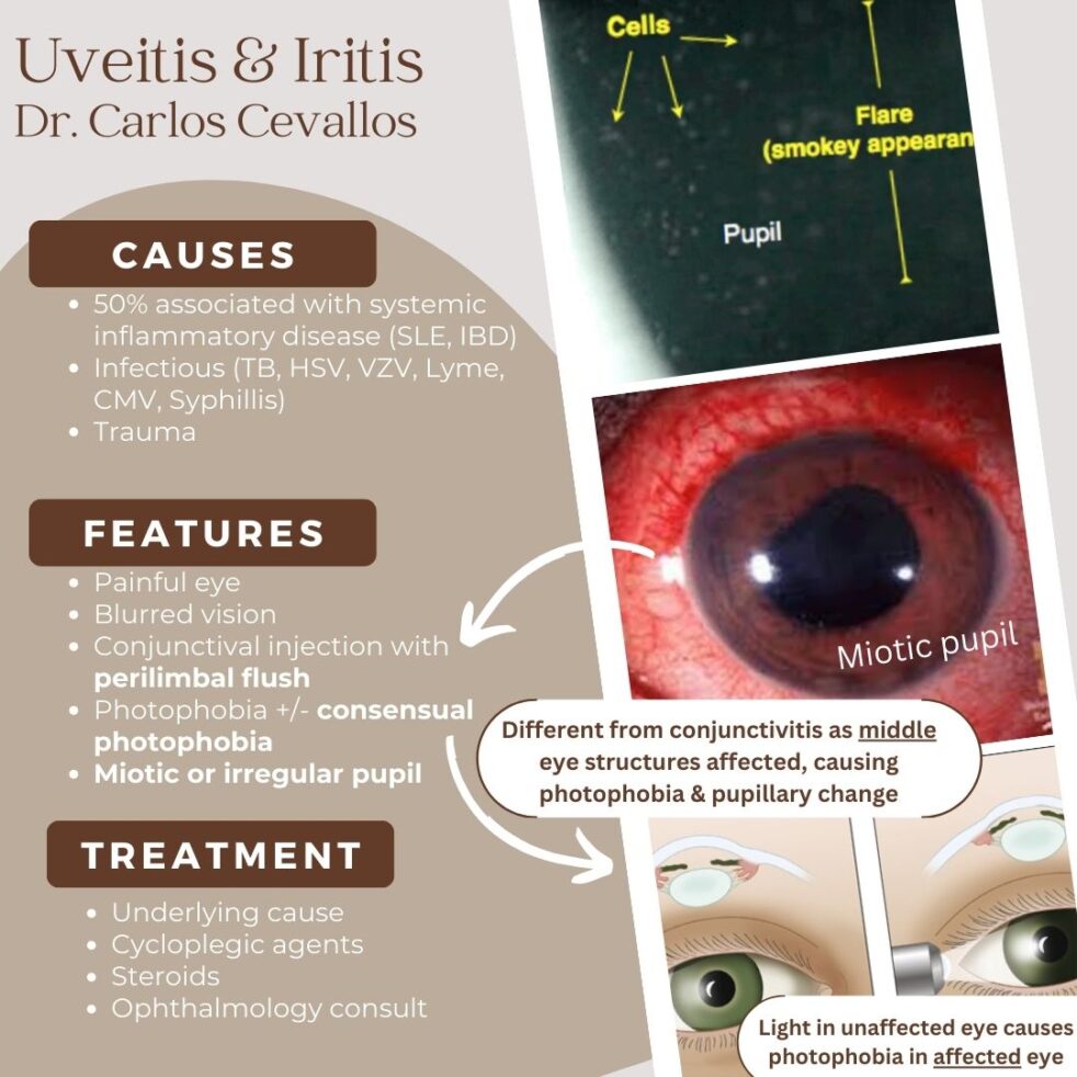 Uveitis and Iritis with Dr. Carlos Cevallos - EM Daily