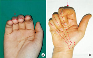 Advanced Cases: Metacarpal Fractures