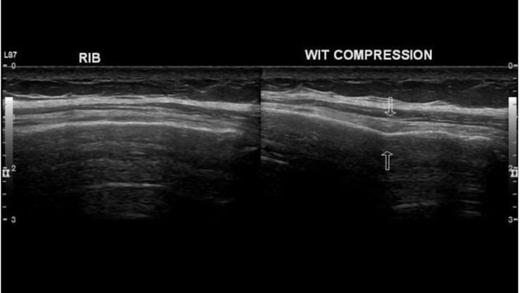 Rib Fractures Part 1: Dr. DeMarzo - EM Daily
