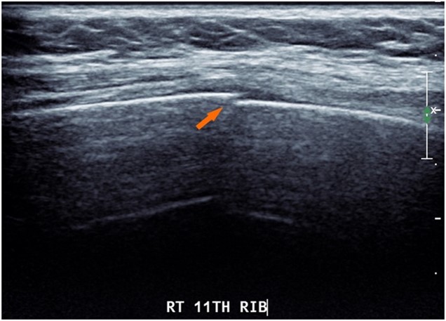Rib Fractures Part 1: Dr. DeMarzo - EM Daily