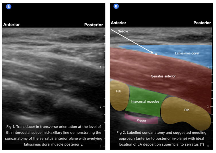 Rib Fractures part 2/Serratus Anterior Nerve Block: By Dr. DeMarzo - EM ...